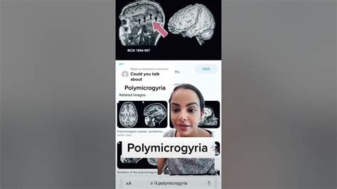 Polymicrogyria Youtube