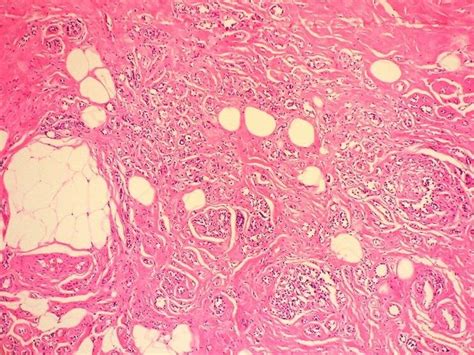 Sclerosing Adenosis Abnormally Dense Intralobular Connective Tissue