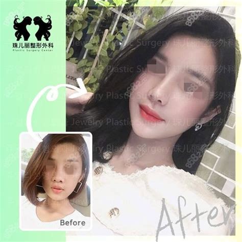 缩鼻翼手术一定会留疤吗韩国这几家医院做鼻翼缩小技术好鼻翼整形 8682整形网