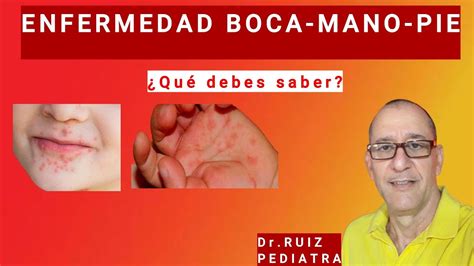 Enfermedad Boca Mano Pie ¿qué Es Y Cómo Se Contagia Youtube