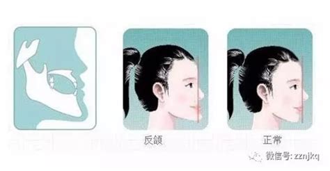 什么叫咬合翼片的图片 牙合翼片示意图 牙合翼片 大山谷图库