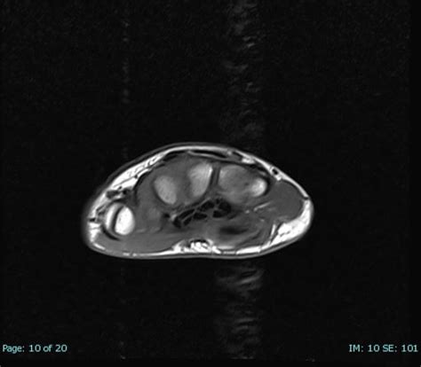 Ulnar Artery Pseudoaneurysm Image