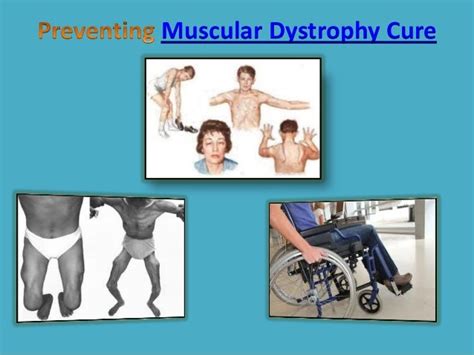 Symptoms Of Muscular Dystrophy