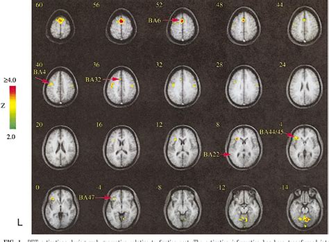 Figure 1 From Intersubject Variability In Cortical Activations During A