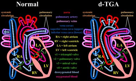 Dextro Transposition Of The Great Arteries Wikidoc