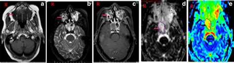 Mri Of Case 10 Showingan Abnormal Signal In The Right Maxillary Sinus