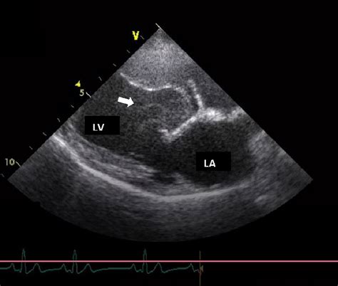 Right Parasternal Long Axis View Of Left Atrium La And Ventricle Lv