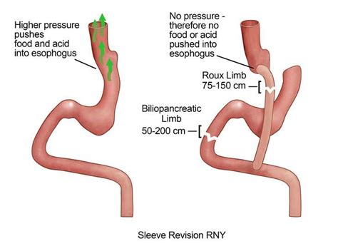 Reflux After Sleeve Gastrectomy Bariatric Surgery Ucla Health