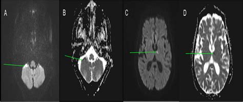 A Axial Section Magnetic Resonance Imaging Of The Brain Showing