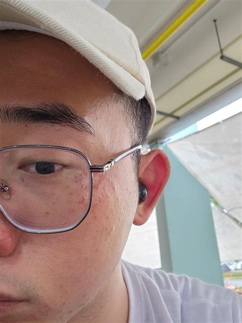 Is This Kp Rkeratosis