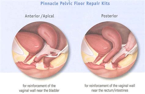 Mesh Grafting For Pelvic Floor Reconstruction Obstetrics And