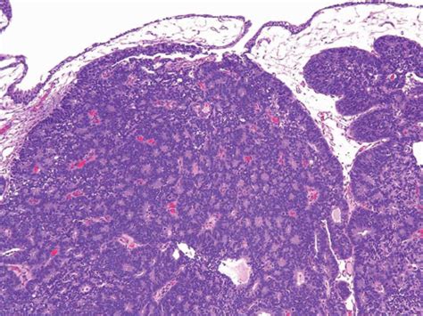 Secondary Tumors Of The Bladder Abdominal Key
