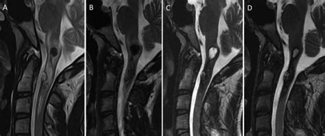 Spinal Cavernomas Mri T1 Signal Evolution Of Bleeding Cavernoma Upper