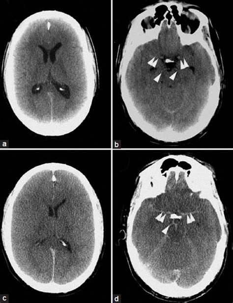 Axial Noncontrast Enhanced Computed Tomography NCCT Head Images