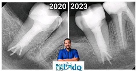 There Is 2 Types Of Errors In Rct Errors That Needs Intervention As Ledge Perforation