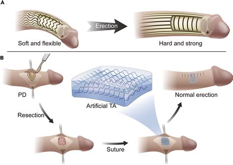 Bionic Artificial Penile Tunica Albuginea Matter