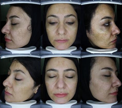 Treatment With Txa Mesoneedling On The Left And Txa Microinjection On Download Scientific