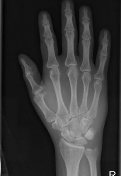 Pisiform Fracture Symptoms