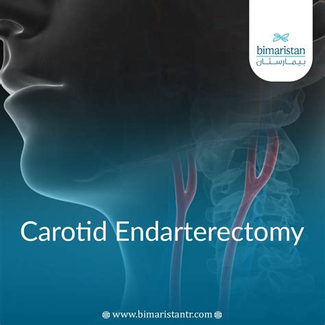 Carotid Endarterectomy In Turkey Bimaristan