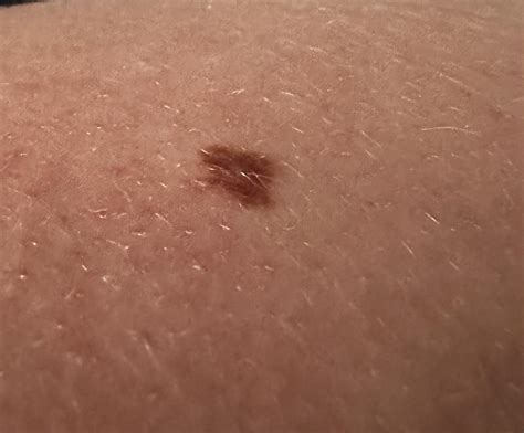 I Found This Weirdly Shaped Mole On My Arm Is It Cancer Should I Get