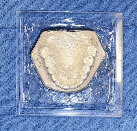 Novel Custom Maxillary Disimpaction Splint Plastic And Reconstructive Surgery Global Open