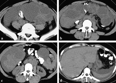 Bilateral Undifferentiated Ovarian Carcinomas In A 34 Year Old