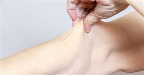 Does Liposuction Cause Loose Skin 2025