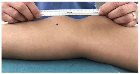 Pdf] Apophysitis Of The Tibial Tuberosity Osgood Schlatter 42 Off