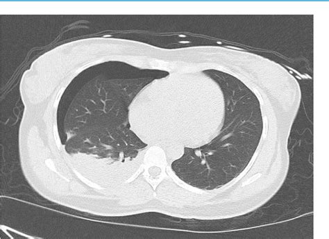 Figure 1 From Refractory Thoracic Endometriosis Semantic Scholar