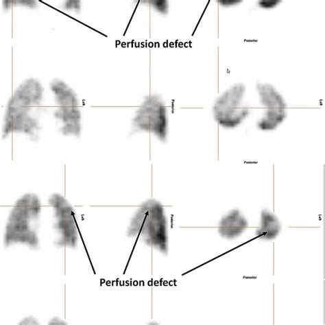 Top Pulmonary Ventilation Perfusion Scan Showing Perfusion Defect In Download Scientific