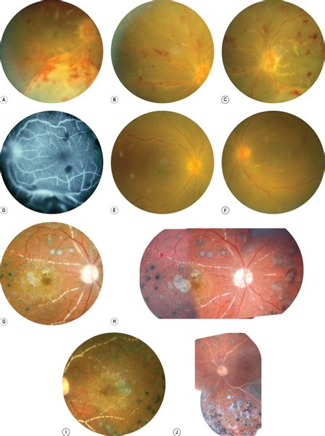 Inflammatory Diseases Of The Retina Ento Key
