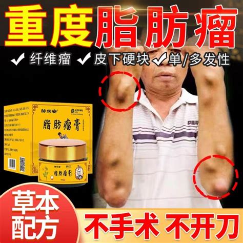 Herbal Lipoma Removal Cream For Removing Multiple Single Lipoma