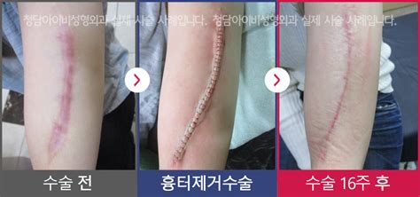 팔 비후성반흔 흉 제거 수술 16주 후 흉터치료 전후 청담아이비성형외과