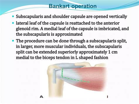 Recurrent Shoulder Dislocation Ppt