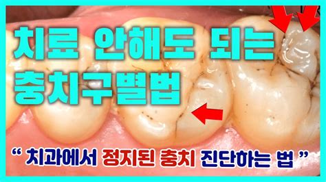 치과 충치치료 받기전 보면 좋은 영상 Feat 진행되다 멈춘 충치 정지우식 Youtube