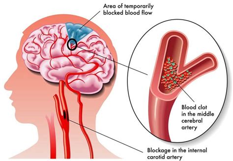 Apoplexy Cerebral Apoplexy Pituitary Apoplexy Causes Symptoms