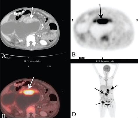 Case Report Cholangiocarcinoma In A Choledochal Cyst Abstract