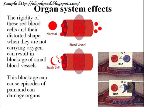 Explore Sickle Cell Anemia Powerpoint Presentation Slide Free Power