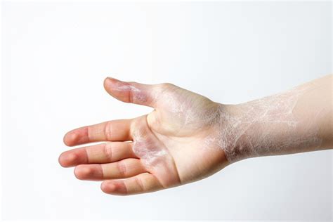 Premium Ai Image Skin Diseasesallergies Psoriasis Eczema Dermatitis