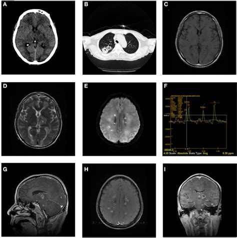 Figure 1 From Multifocal Brain Abscesses Caused By Invasive