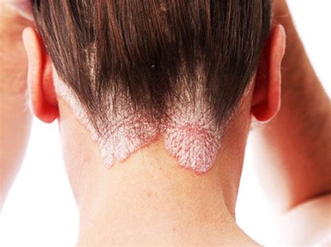 Gross Skin Diseases