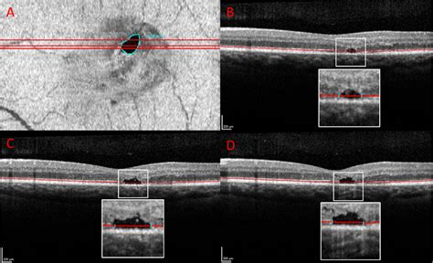 Figure 1 From Relative Ellipsoid Zone Reflectivity In Macular