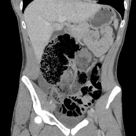 Abdominal Ct Showing A Distended And Medially Located Cecum With