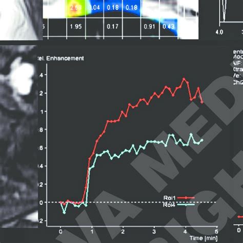 —patient Age 58 Years With Prostate Specific Antigen Level Of 52