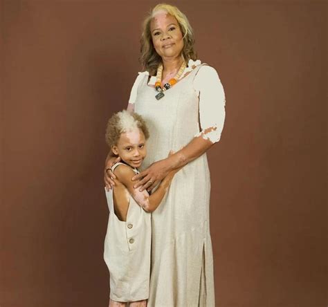 با ساموئل کوچولو، پسری با بیماری ژنتیکی نادر که به یک سوپر مدل تبدیل شد