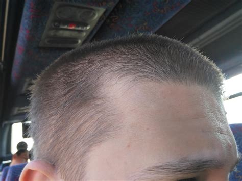 Just Shaved My Hair Yo Think My Temple Is Thinning Every Other Part Of The Head Seems To