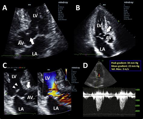 Subaortic Membrane Coexisting With Systolic Anterior Motion Of The