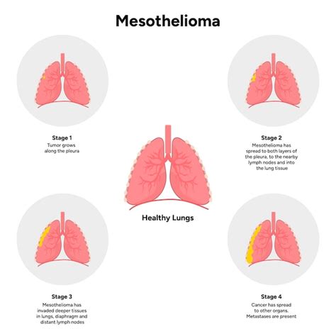 Premium Vector 4 Stages Of Mesothelioma Lung Disease