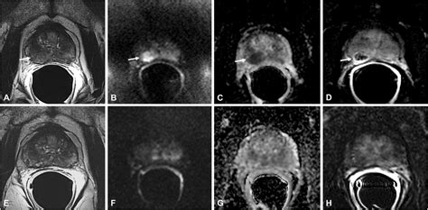Bacillus Calmette Guérin Induced Granulomatous Prostatitis In A Download Scientific Diagram
