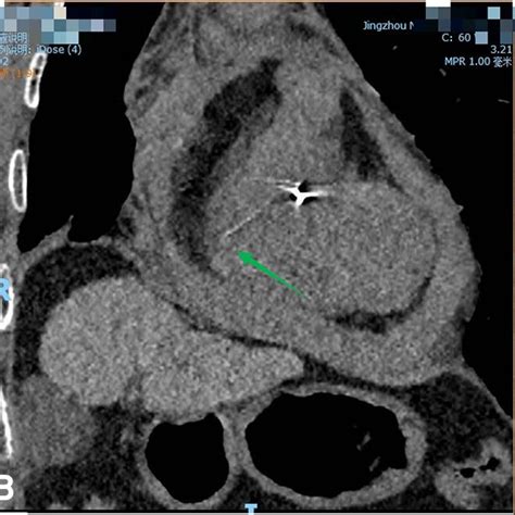 A Preoperative Chest Ct Coronal Plane B Postoperative Chest Ct